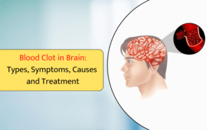 Blood Clot in Brain: Types, Symptoms, Causes, and Treatment – Dr. Ninad ...