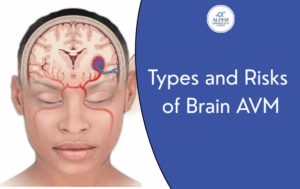 Types of Brain AVM: Size, Location, and Risk Factors – Dr. Ninad Patil